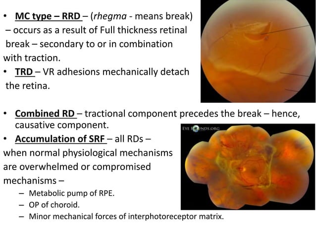Pathogenetic mechanism of Retinal Detachment | PPTX