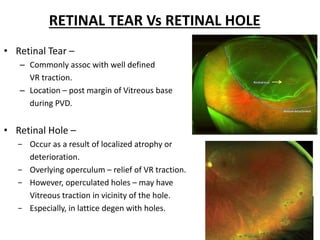 Pathogenetic mechanism of Retinal Detachment | PPTX