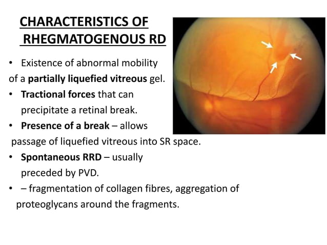 Pathogenetic mechanism of Retinal Detachment | PPTX