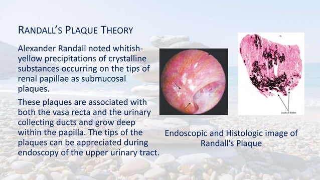 Pathogenesis of Urolithiasis | PPT