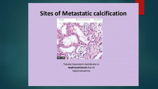 Pathological Calcification | PPTX