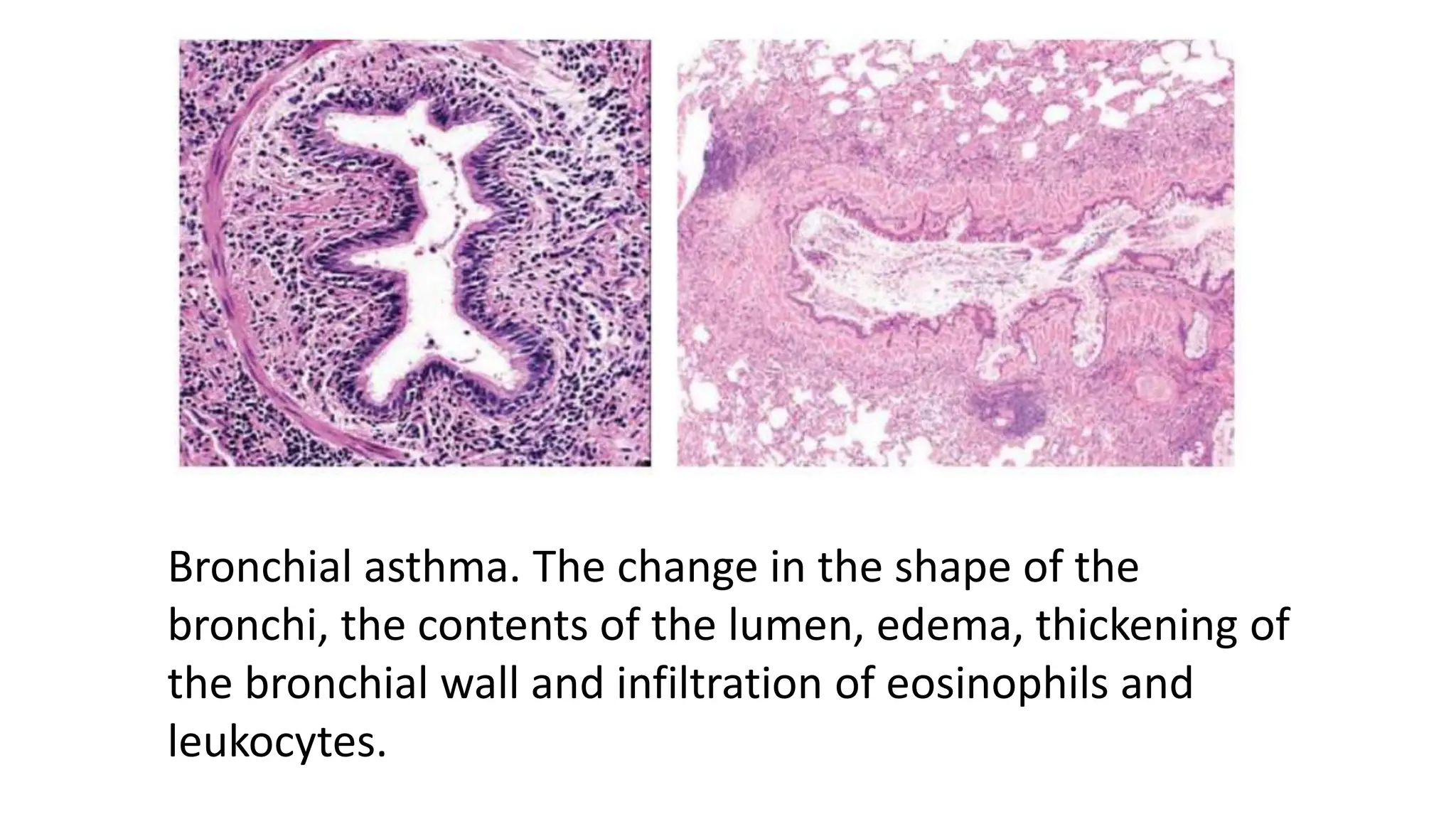 Pathological anatomy of chronic bronchitis, bronchiectasis..pptx