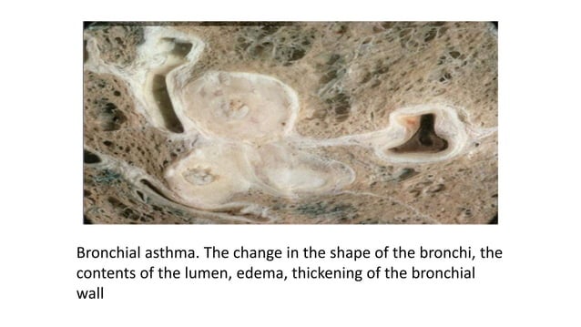 Pathological anatomy of chronic bronchitis, bronchiectasis..pptx
