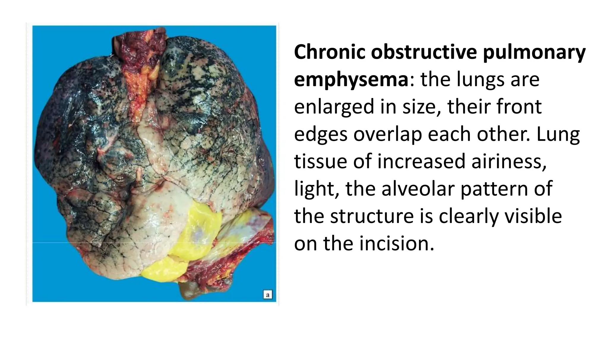 Pathological anatomy of emphysema, pneumosclerosis.pptx
