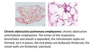 Pathological anatomy of emphysema, pneumosclerosis.pptx