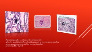 Pathological Calcification | PPTX