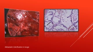 Pathological Calcification | PPTX