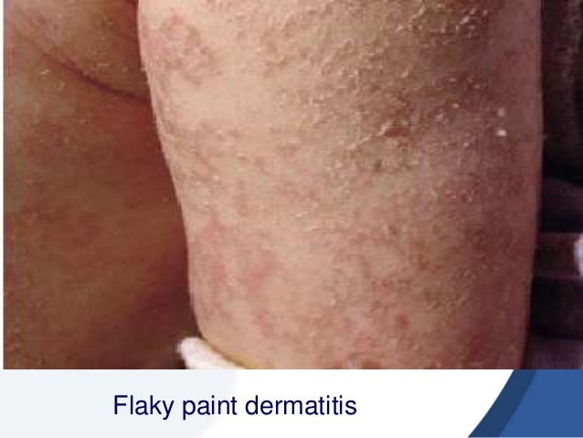 Pathological changes in pem