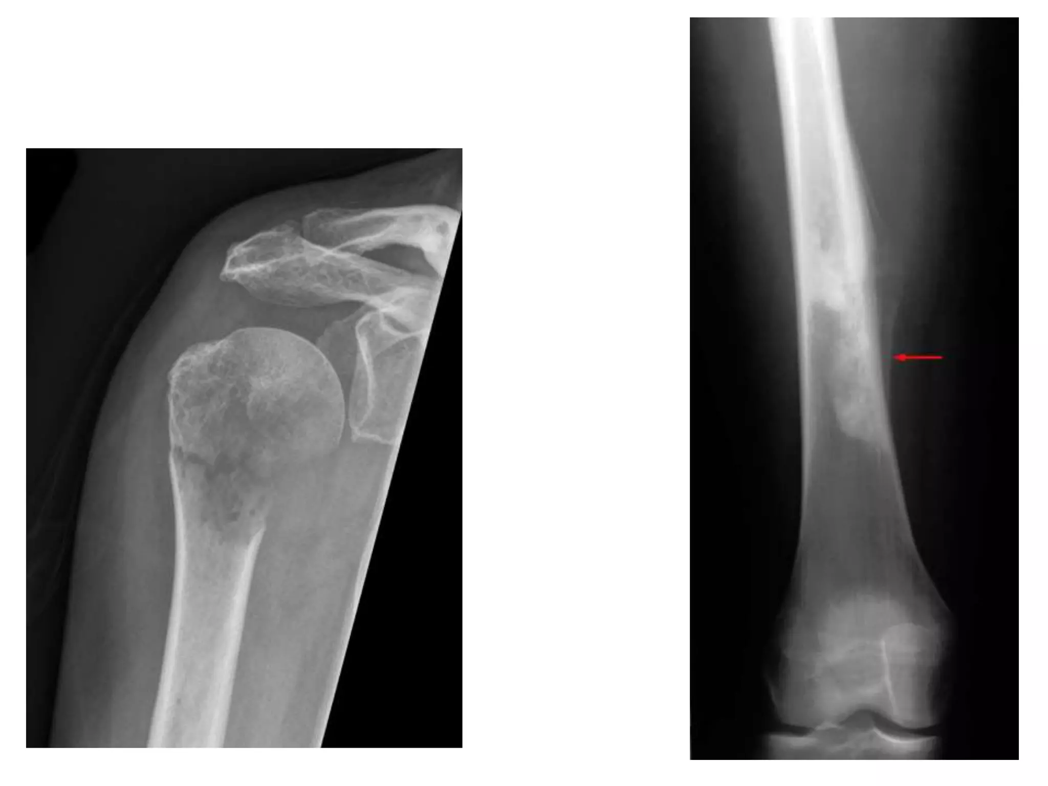 Pathological fractures | PPTX