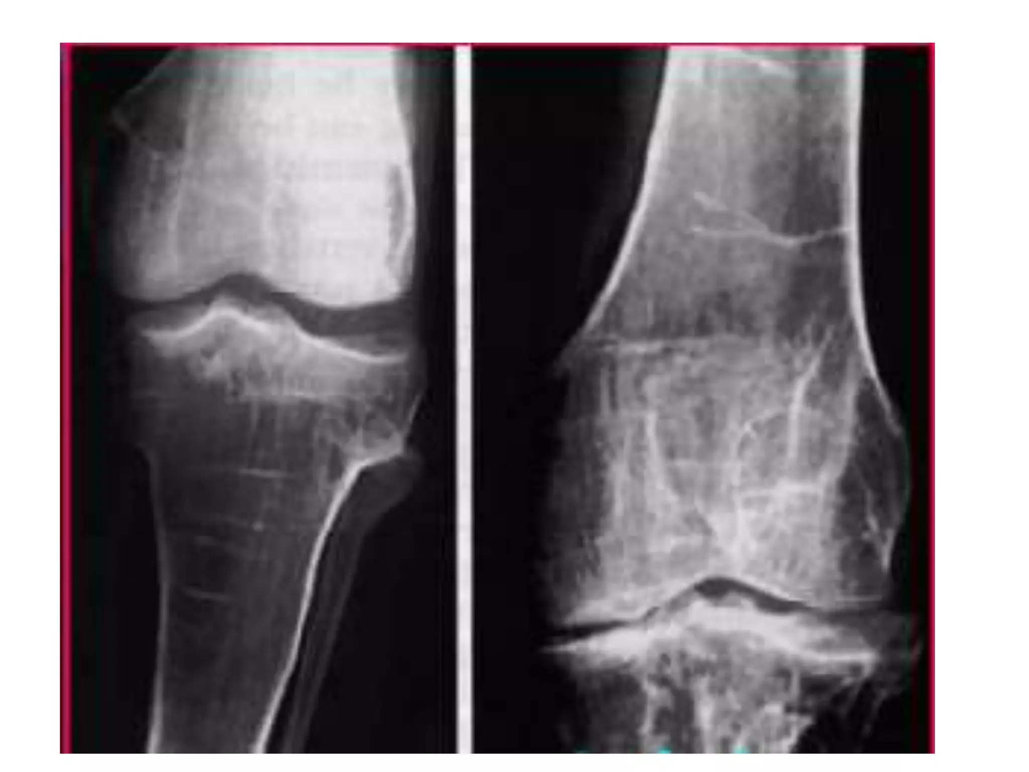 Pathological fractures | PPTX
