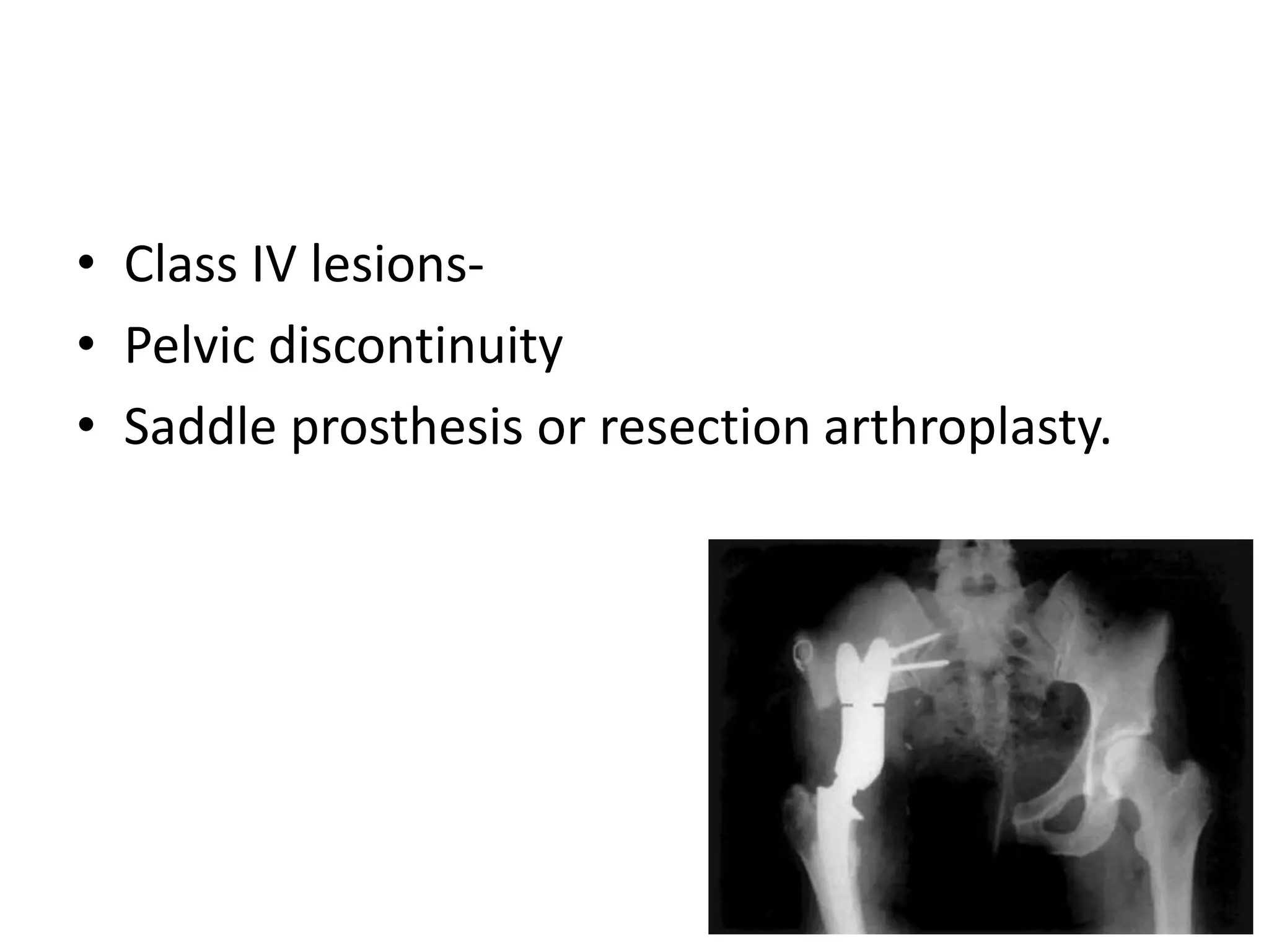Pathological fractures | PPTX