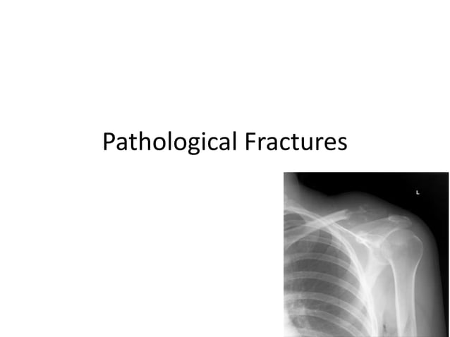 Pathological fractures | PPTX | Bone and Joint Conditions | Diseases ...