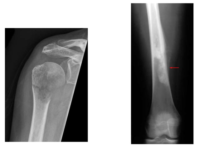 Pathological fractures | PPTX | Bone and Joint Conditions | Diseases ...