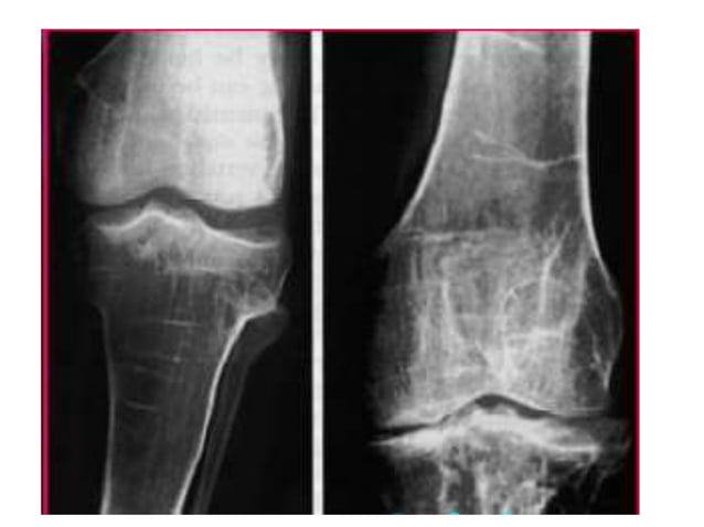 Pathological fractures | PPTX | Bone and Joint Conditions | Diseases ...