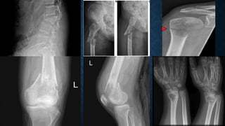 Pathological fractures by dr bipul borthakur, smch, assam | PPTX