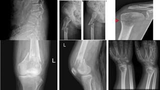 Pathological fractures | PPTX