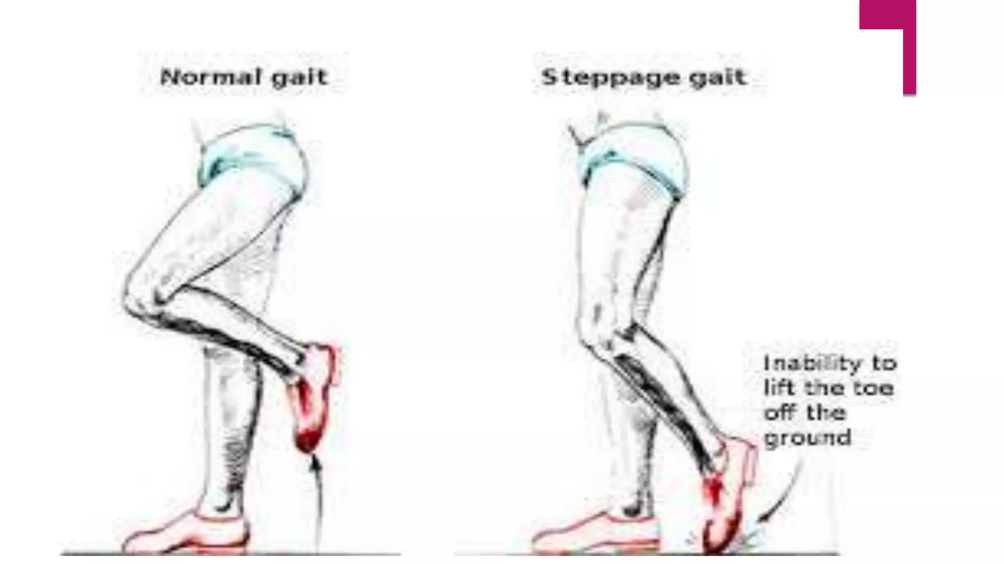 PHYSIOTHERAPY JUNOON Dr.Vinita Pathological gait series 3 | PPT