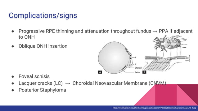 Pathological Myopia and how it can effect CL Rx | PPT