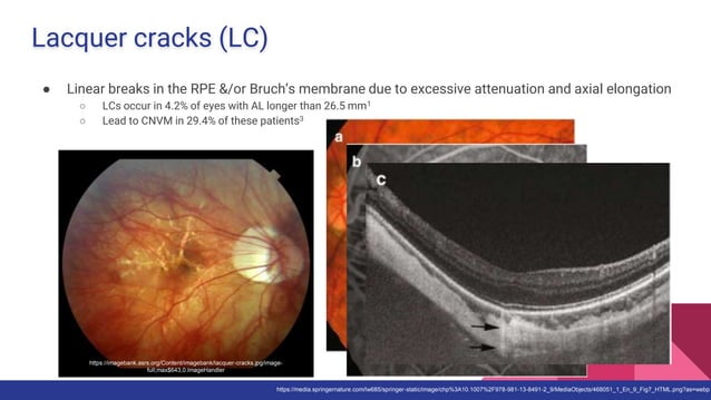 Pathological Myopia and how it can effect CL Rx | PPT