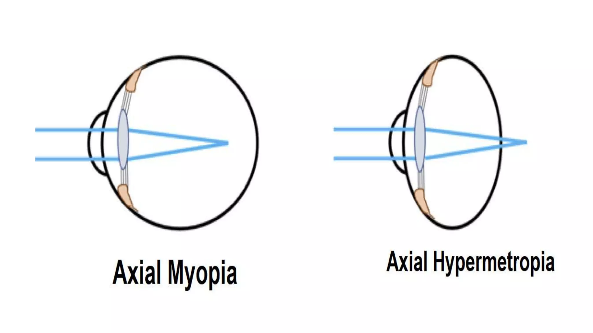 Pathological optical defects | PPTX | Eye and Vision Conditions ...