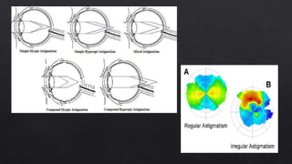 Pathological optical defects | PPTX
