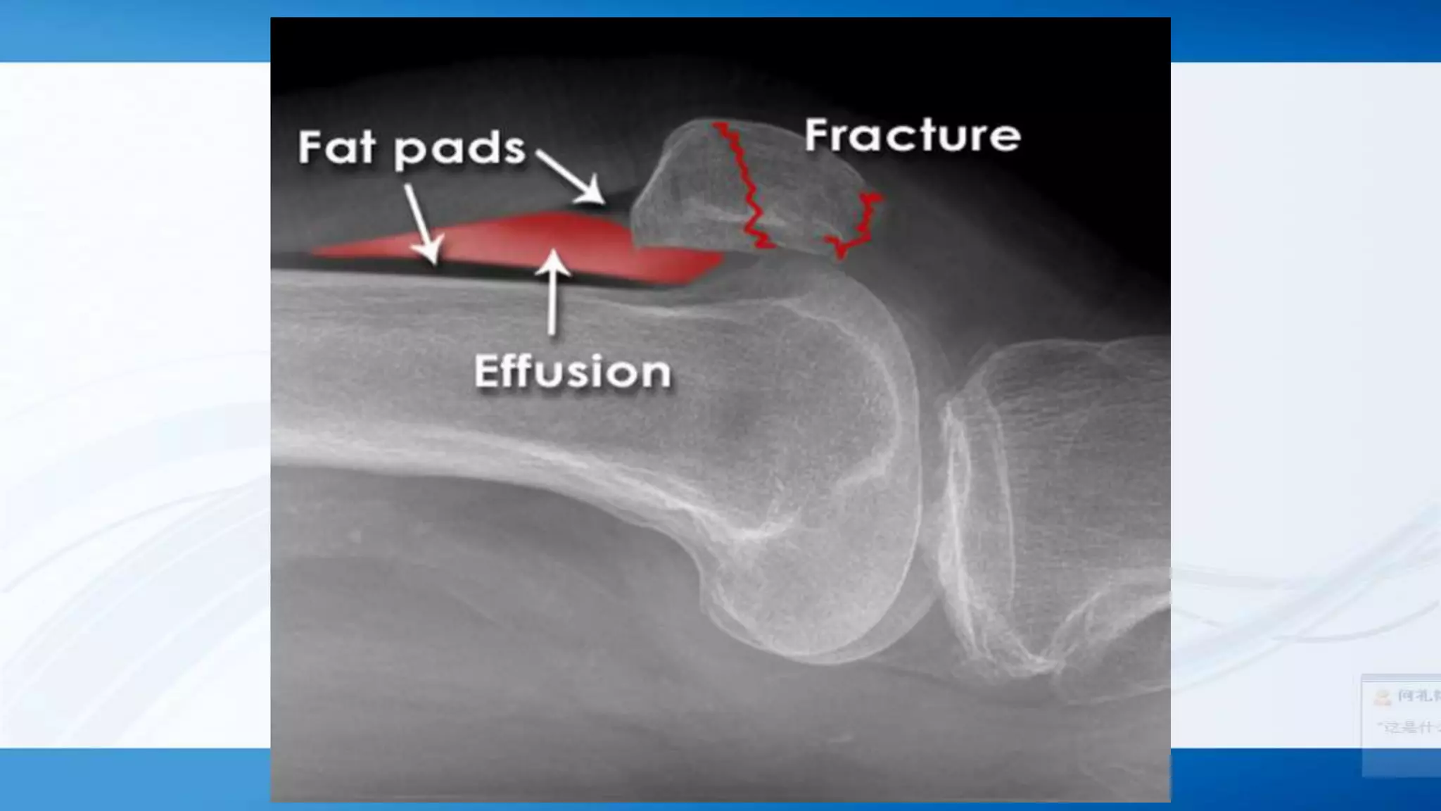 Pathological significance of soft tissue and fat planes | PPTX