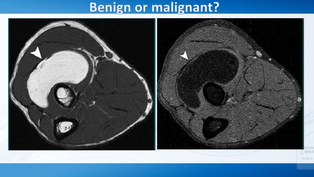 Pathological significance of soft tissue and fat planes | PPTX | Death ...