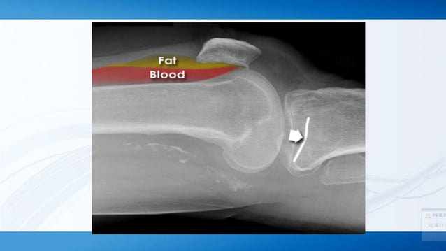 Pathological significance of soft tissue and fat planes | PPTX | Death ...