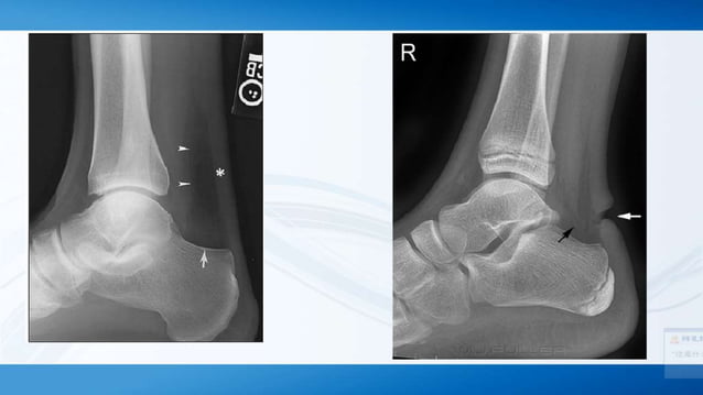 Pathological significance of soft tissue and fat planes | PPTX | Death ...