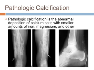 Pathologic calcification | PPT