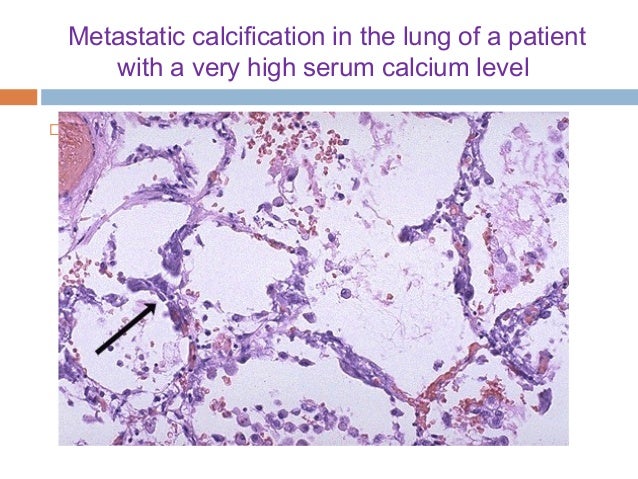 Pathologic calcification