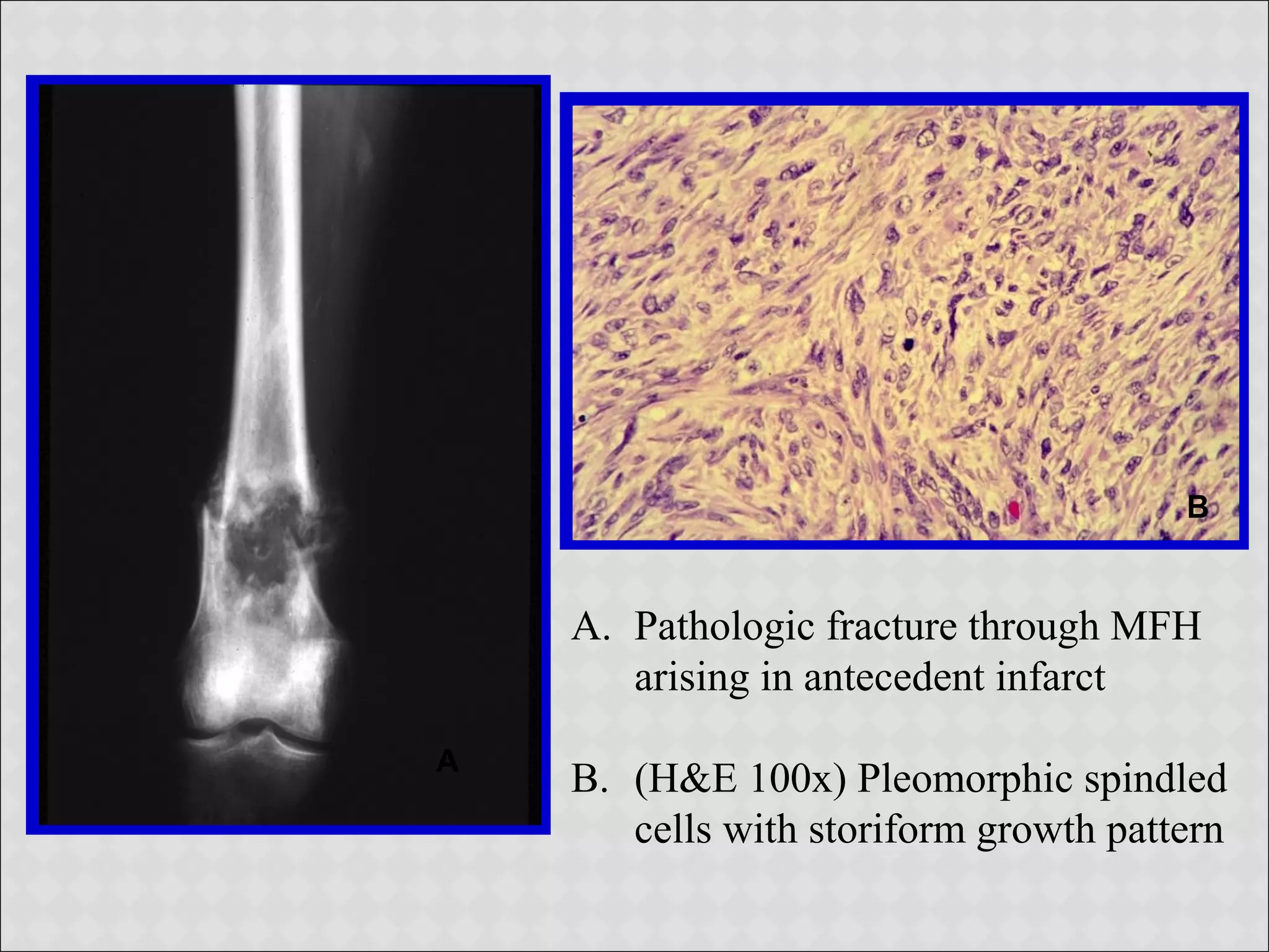 Pathologic fractures | PPT