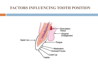 Pathologic migration | PPTX