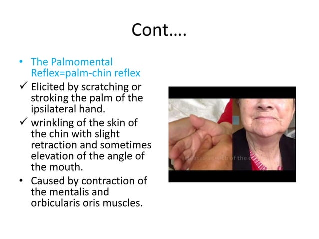 Pathologic Reflexes, Monofilament Tests & Meningeal Signs.pptx | Death ...