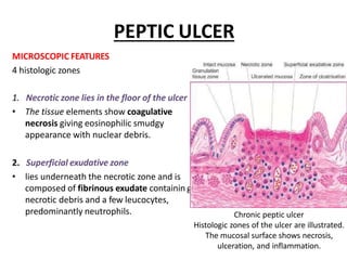 pathologiesofthegastrointestinaltract-180901164714.pptx