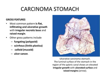 pathologiesofthegastrointestinaltract-180901164714.pptx