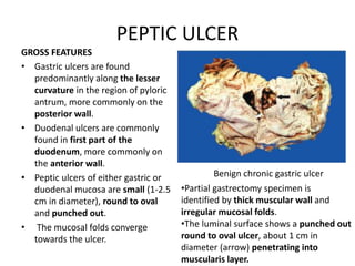 Pathologies of the gastrointestinal tract | PPTX