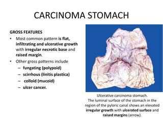 Pathologies of the gastrointestinal tract | PPTX