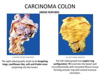 Pathologies of the gastrointestinal tract | PPT