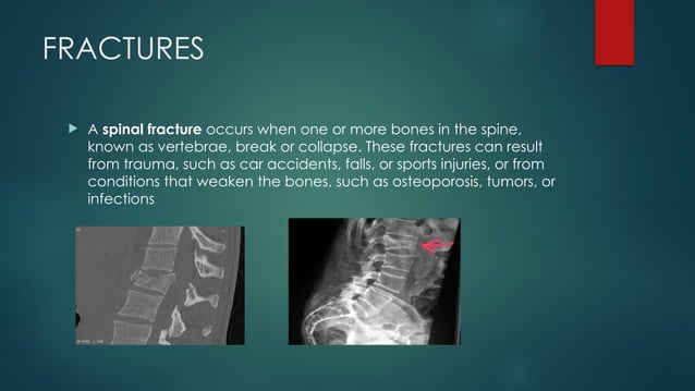 Introduction to Pathologies of the spine-1.pptx | Death, Injury, or ...