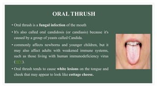 Pathologies of tongue detail presentation | PPTX
