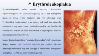 Oral Leukoplakia/ Pathology of Gastrointestinal tract.pptx