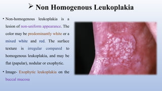 Oral Leukoplakia/ Pathology of Gastrointestinal tract.pptx