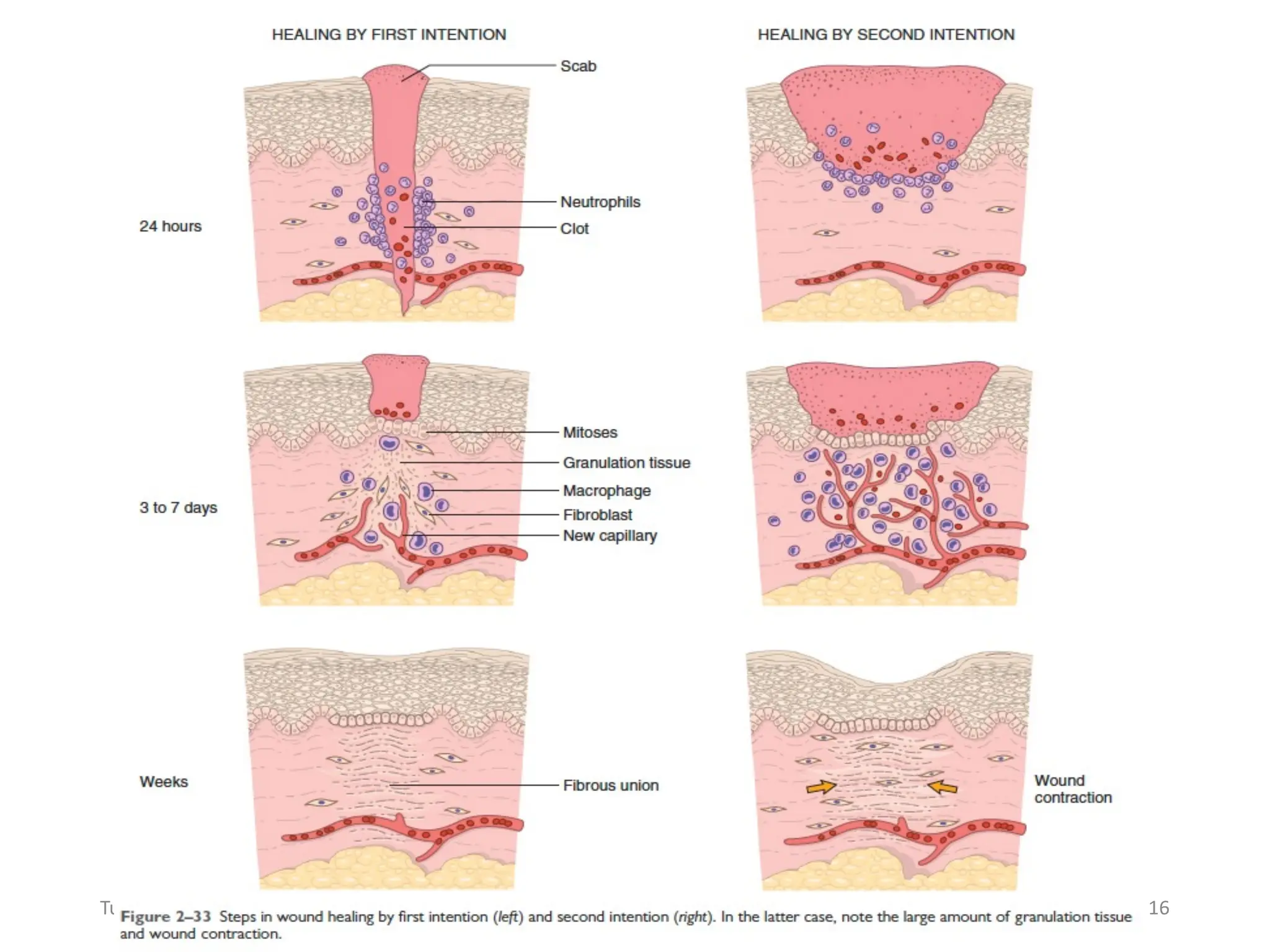 PATHOLOGY - lecture - Healing & Repair.pdf