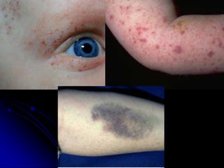 Pathology-bleeding disorders.ppt