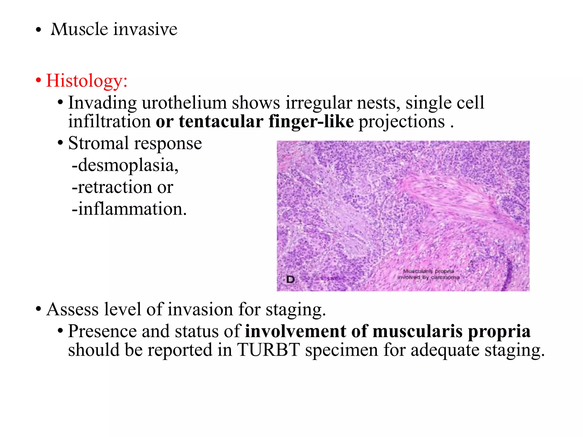 Pathology ca bladder | PPTX