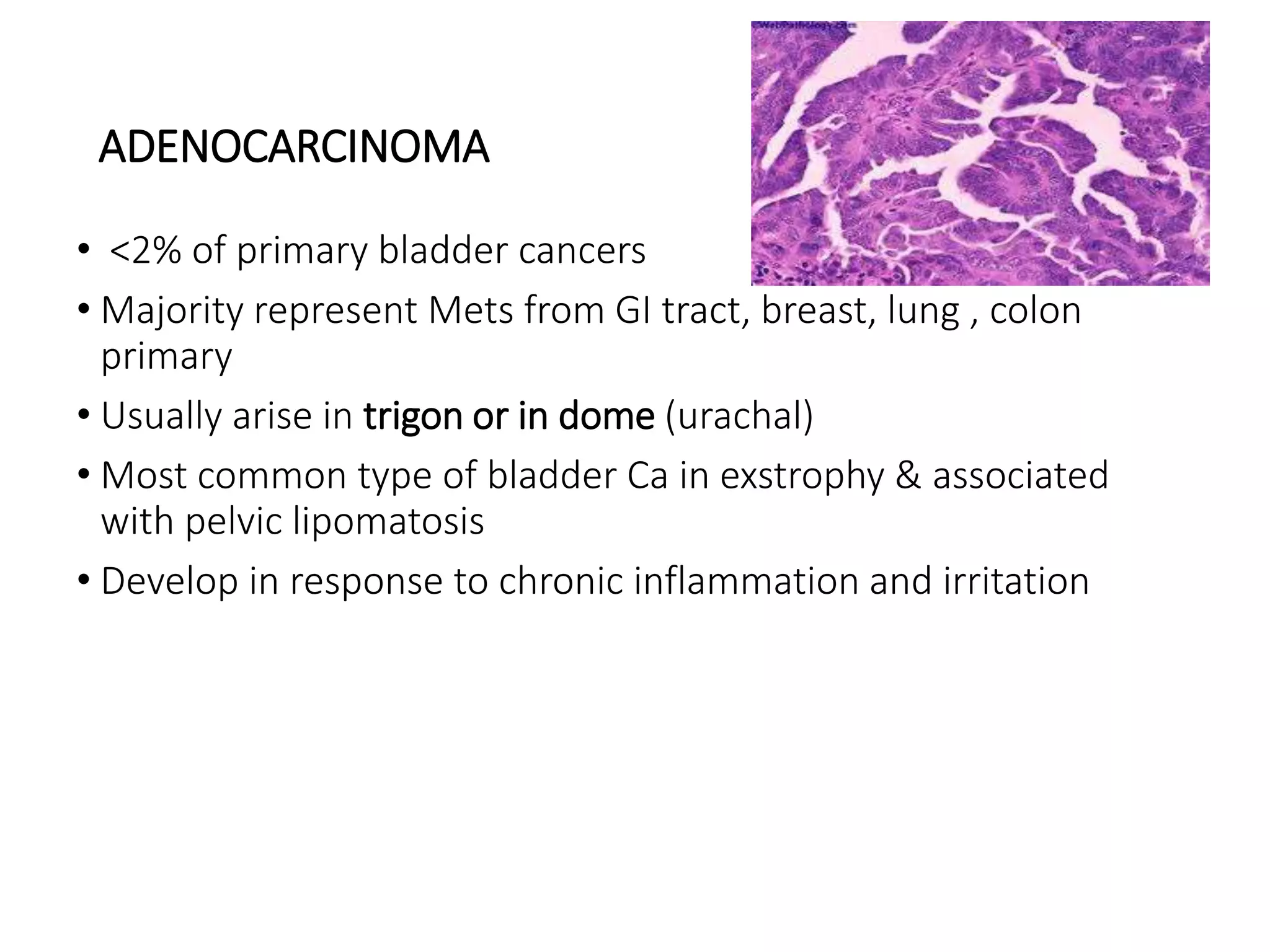 Pathology ca bladder | PPTX