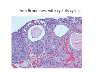 Pathology ca bladder | PPTX
