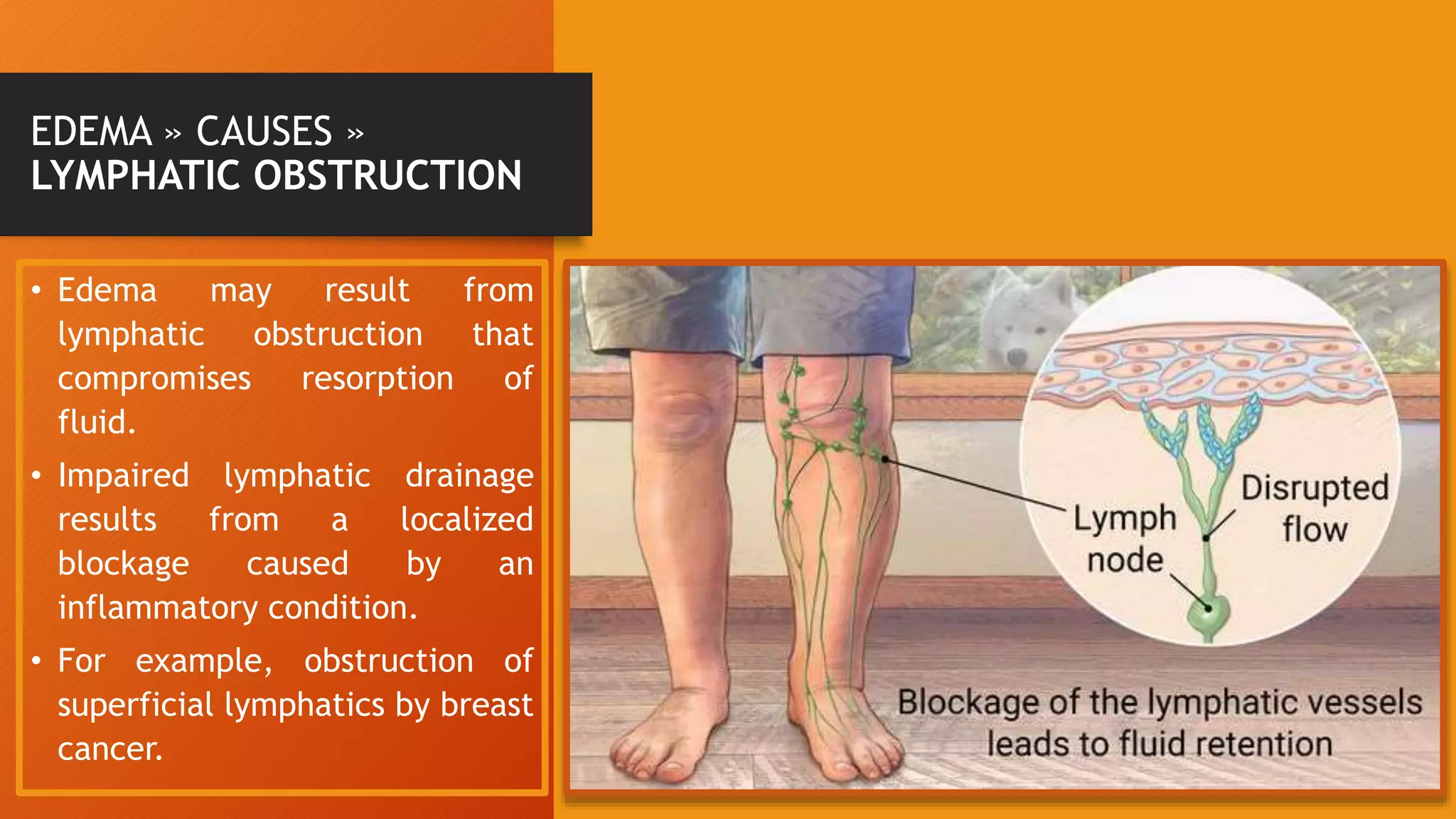 Pathology - Edema.pptx