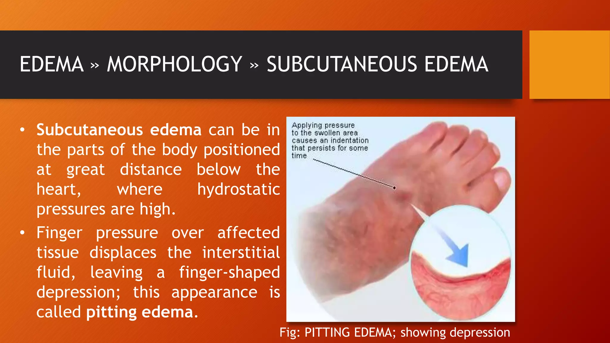 Pathology - Edema.pptx